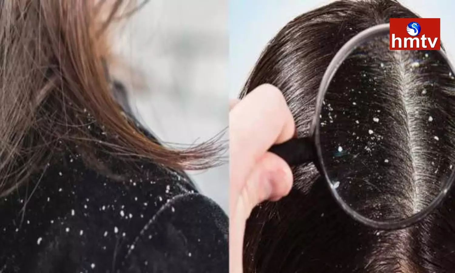 Take These Precautions When Having Dandruff Problem Get Rid of Dandruff ...